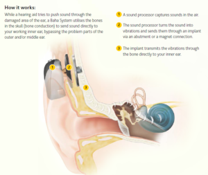 Bone Anchored hearing aids (BAHA) Who? How? Why?